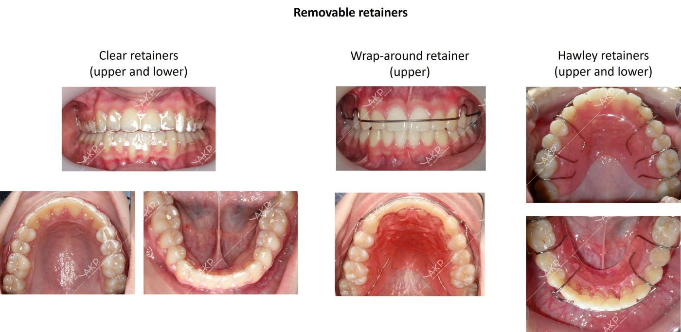 Orthodontic Retension - AKP