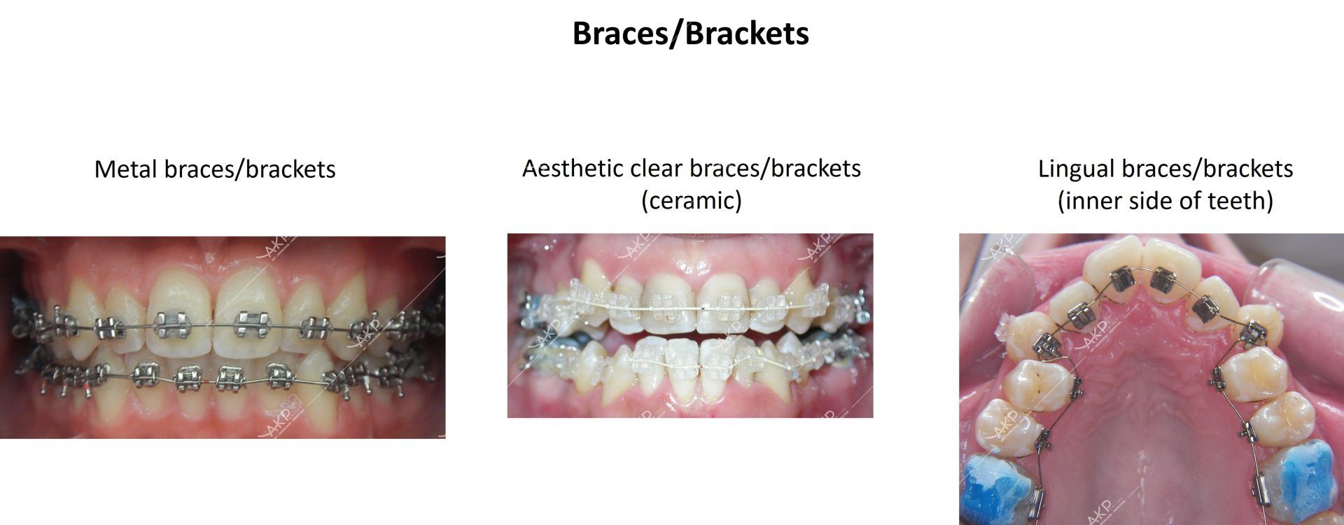 Orthodontic Appliances - AKP