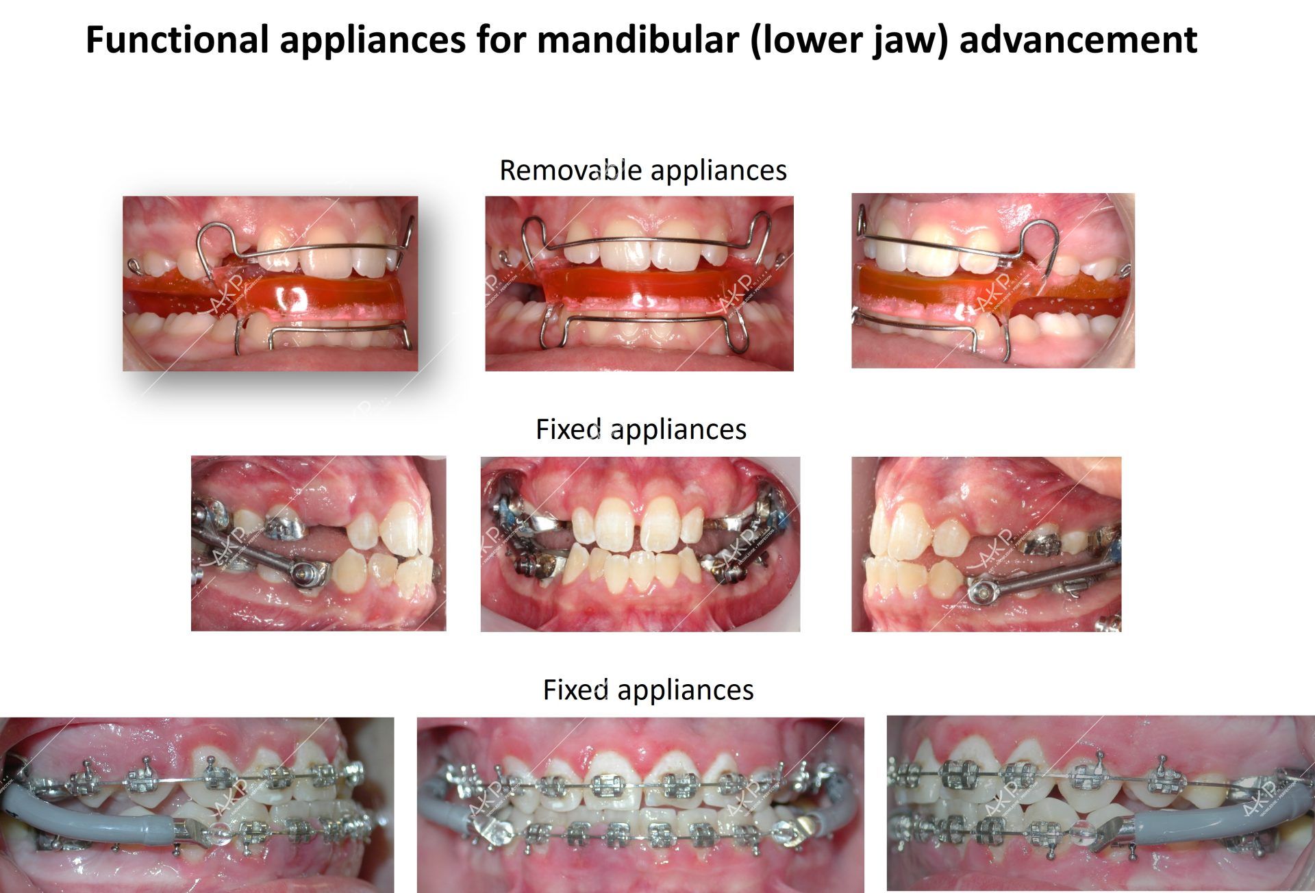 Orthodontic Appliances - AKP