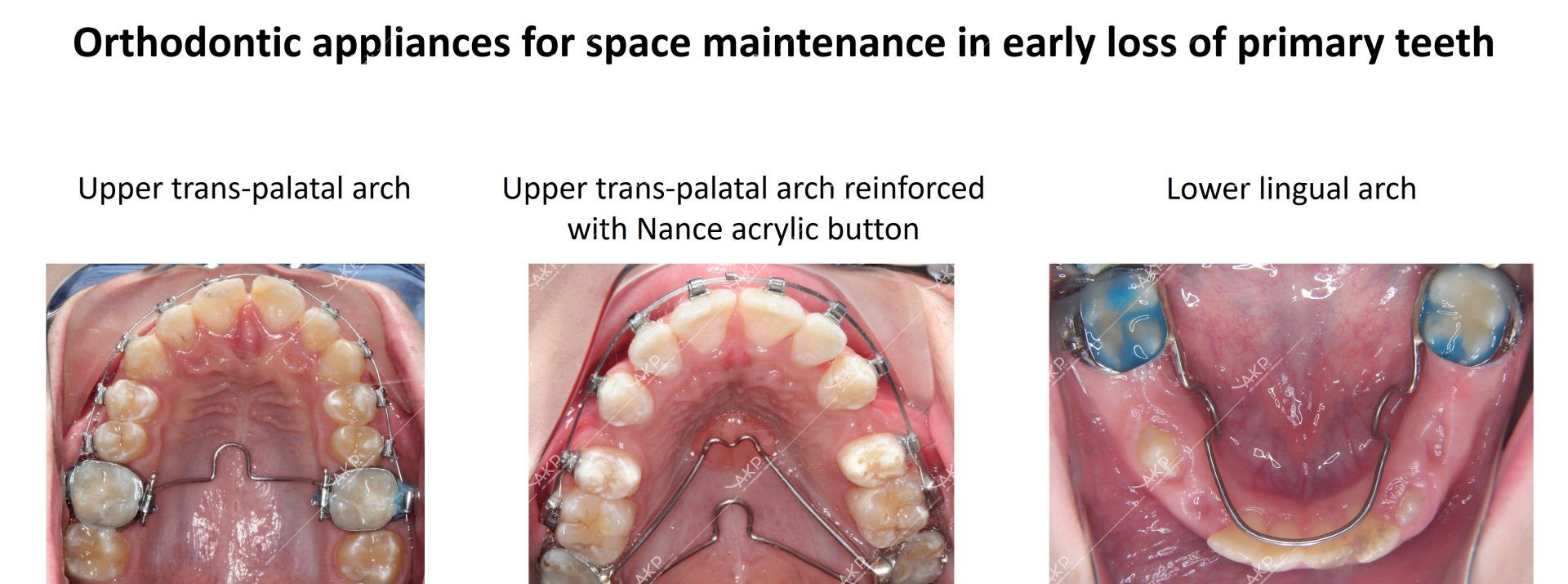 Orthodontic Appliances - AKP